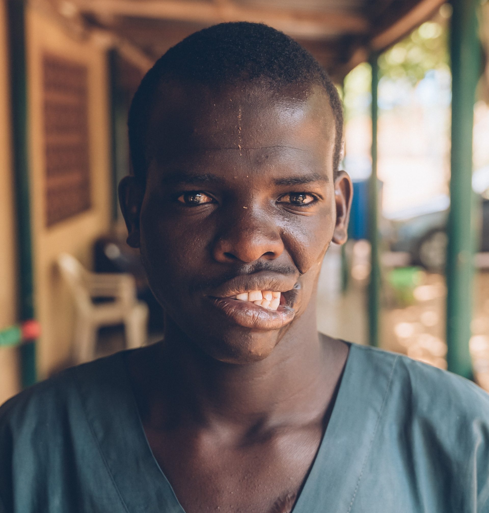 Three survivors of noma, a disease that should no longer exist ...